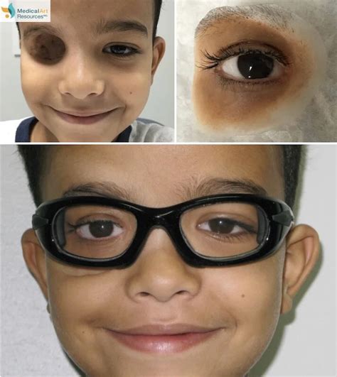 Types Of Eye Prosthesis At Paul Bullock Blog
