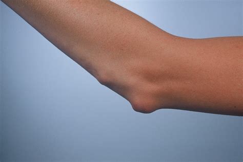 Elbow Rheumexam Atlas