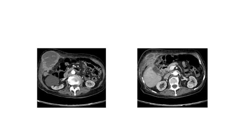 Right Hypochondrial Masses Pptx