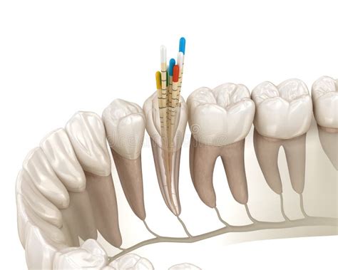 Endodontic Root Canal Treatment Process Medically Accurate Tooth 3d