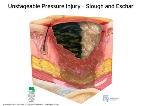 Pressure Ulcer Home Health Slough