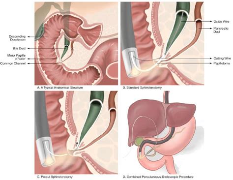 A A Typical Anatomical Structure B Endoscopic Biliary