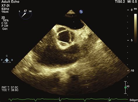 Short Axis View Of Aortic Valve In Midesophageal Window 47° View Of Download Scientific