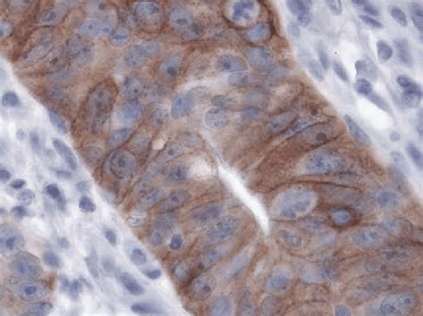 Her2 Immunohistochemistry Showing A Moderate Membranous Staining