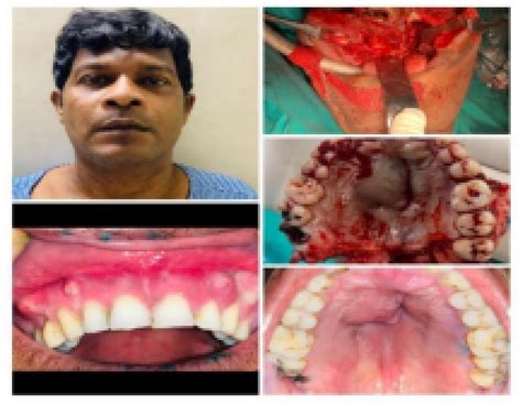 Total Maxillectomy Done In Patient With Bilateral Maxillary Sinus Download Scientific Diagram