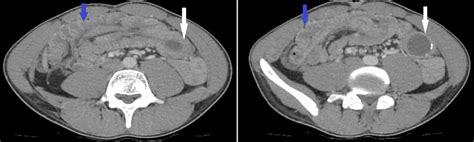 Axial Ct Scan Demonstrated The Ileocecocolic Intussusception Blue