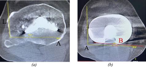 Rotational Alignment Of Tibial Component In Total Knee Arthroplasty Intechopen