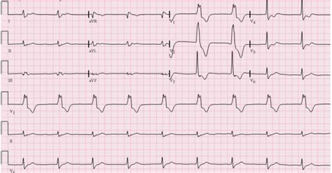 Reperfusion Arrhythmias Resus
