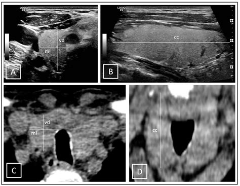 Optimization Of Thyroid Volume Determination By Stitched 3d Ultrasound