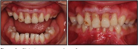 Figure 1 From Oral Self Mutilation Two Case Reports Semantic Scholar