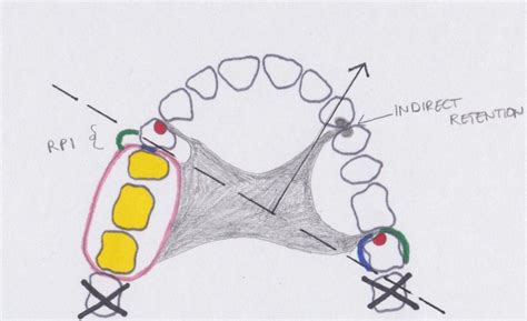 How To Draw Partial Denture Design At Marianne Holt Blog