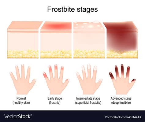 Frostbite Drawing At Victor Adkins Blog