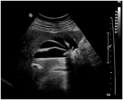 Double Cystic Duct In A Septated Gallbladder Wael Otaibi Giang Quach