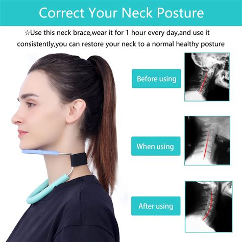 Forward Head Posture Neck Hump