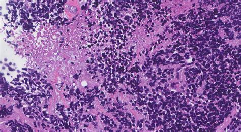 Small Cell Neuroendocrine Carcinoma Of The Lung Atlas Of Pathology