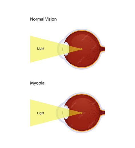 Premium Vector Astigmatism Disease Vector Illustration Design For Medical