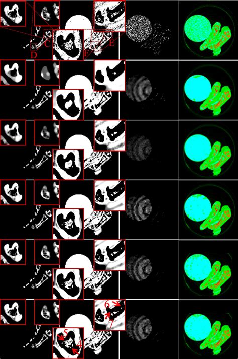 Materials Decomposition Results Of Physical Phantom The 1 St To 4 Th