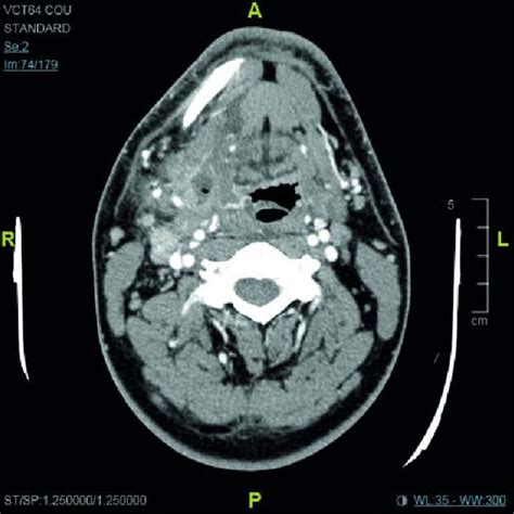 Ct Scan Of The Submandibular Abscess With Infiltration Into The