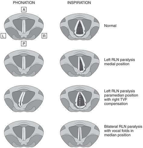 Vocal Fold Paralysis Clinical Tree