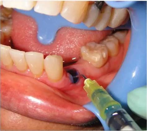 Apical Periodontitis Symptoms Diagnosis Treatment Dentistry