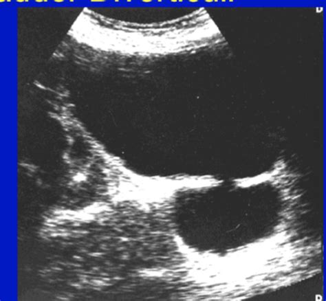 Renal And Bladder Pathology 5 Bladder And Ureters Flashcards Quizlet