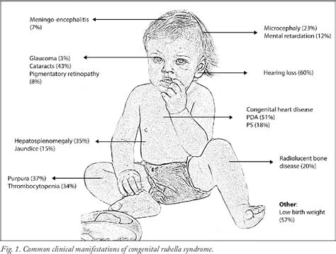 Congenital Rubella Pda