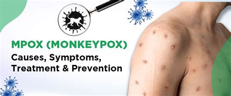 Mpox Monkeypox Causes Symptoms Treatment And Prevention