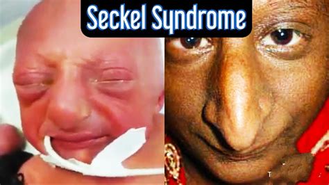 Extremely Rare Congenital Disorder Seckel Syndrome Youtube