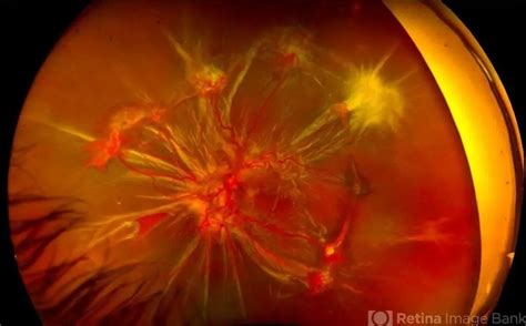 Electro Oculogram Eog A Comprehensive Guide An Eye Care Blog