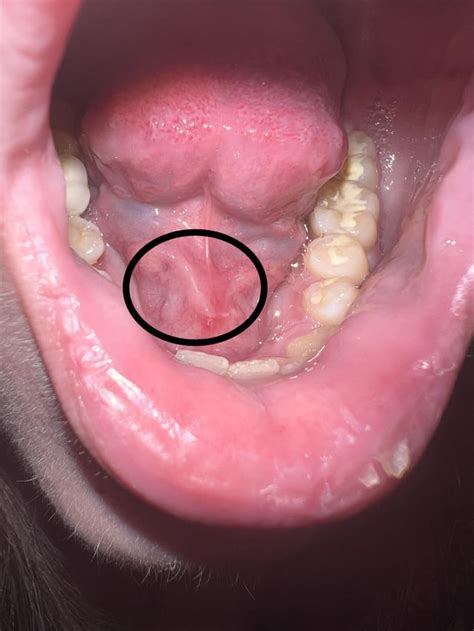Skintag Bubble Bump Under Tongue Rmedicaladvice