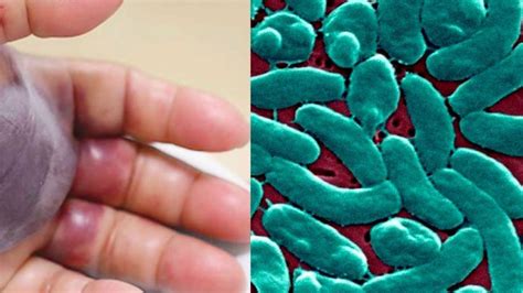 ¡aterradora Bacteria Devoradora De Carne Al Acecho ¿estás A Salvo N24