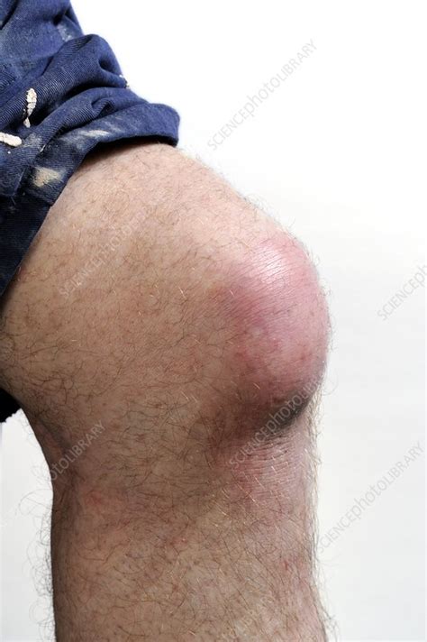 Prepatellar Bursitis Stock Image C0238979 Science Photo Library