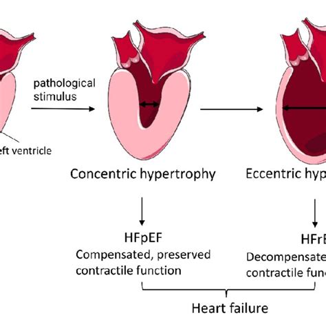 Overview Of Pathological Cardiomyocyte Hypertrophy Pathological Download Scientific Diagram