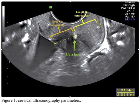 Which Part Of Cervical Length Is Predictive Of Ptb In Women With