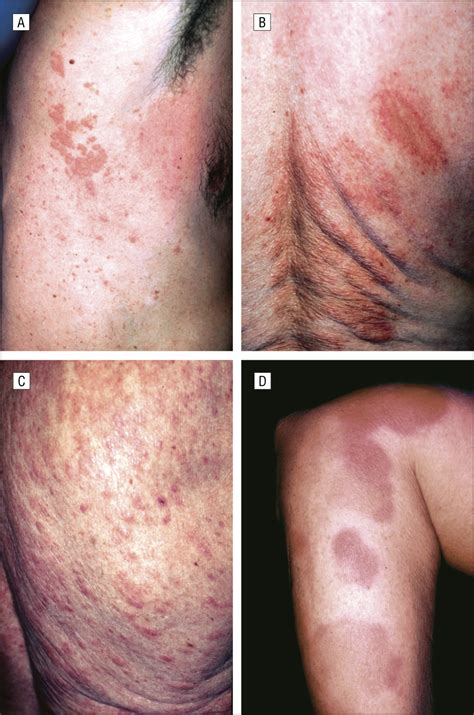 Defining Urticarial Dermatitis A Subset Of Dermal Hypersensitivity