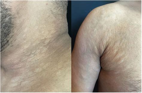 Secondary Syphilis Induced Anetoderma Actas Dermo Sifiliográficas Secondary Syphilis Induced Anetoderma Actas Dermo Sifiliográficas