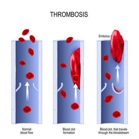 Blood Clot Illustrations Royalty Free Vector Graphics And Clip Art Istock