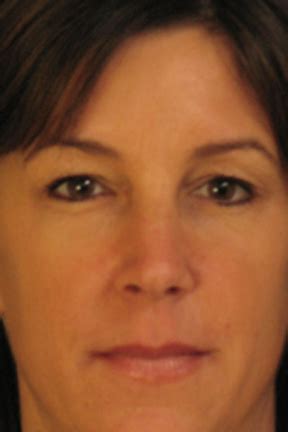 Patient Eyelid Surgery Before And After Photos Marin Plastic Surgery Gallery San