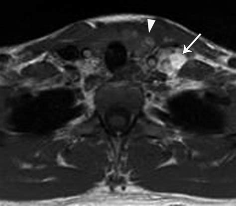 Evaluation Of Cervical Lymph Nodes In Head And Neck Cancer With Ct And