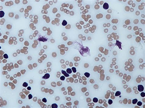 Chronic Lymphocytic Leukemia Cll Oncology Medbullets Step 1