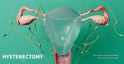 Hysterectomy Surgery In Noida Dr Neha Gupta