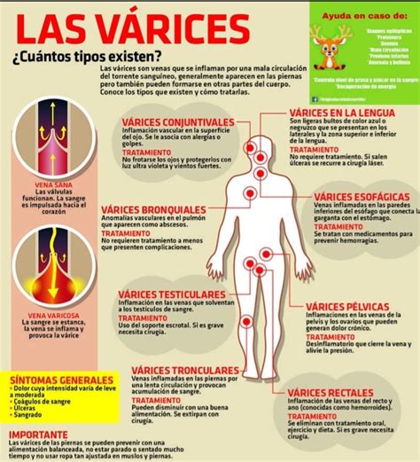 Cuantos Tipos De Varices Rema Productos Organicos
