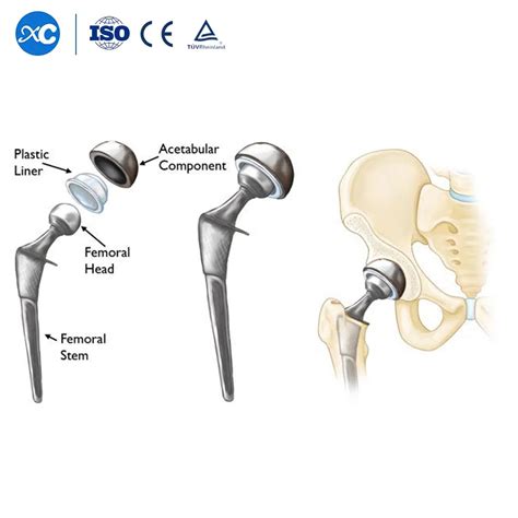 Orthopedic Prosthesis Implant Artificial Hip And Knee Joint Replacement Hip Joint Replacement