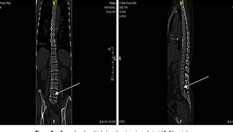 Figure 2 From A Rare Case Of Emphysematous Osteomyelitis Of Spine In Uncontrolled Diabetes