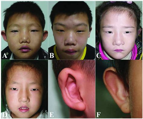 Characteristic Face Of Vcfs These Chinese Vcfs Patients All Presented