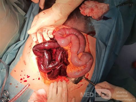 Mesenterial Venous Thrombosis • Image •