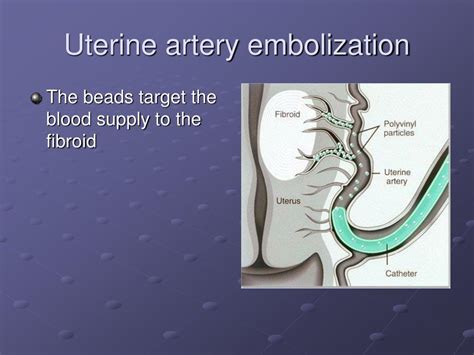 Ppt Uterine Artery Embolization Powerpoint Presentation Free