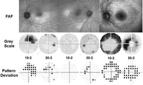 Hydroxychloroquine Induced Retinal Toxicity Pmc