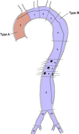 Aortic Arch Stenting Current Strategies New Technologies And Future