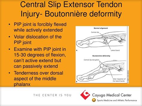 Ppt Common Hand And Wrist Injuries Powerpoint Presentation Free